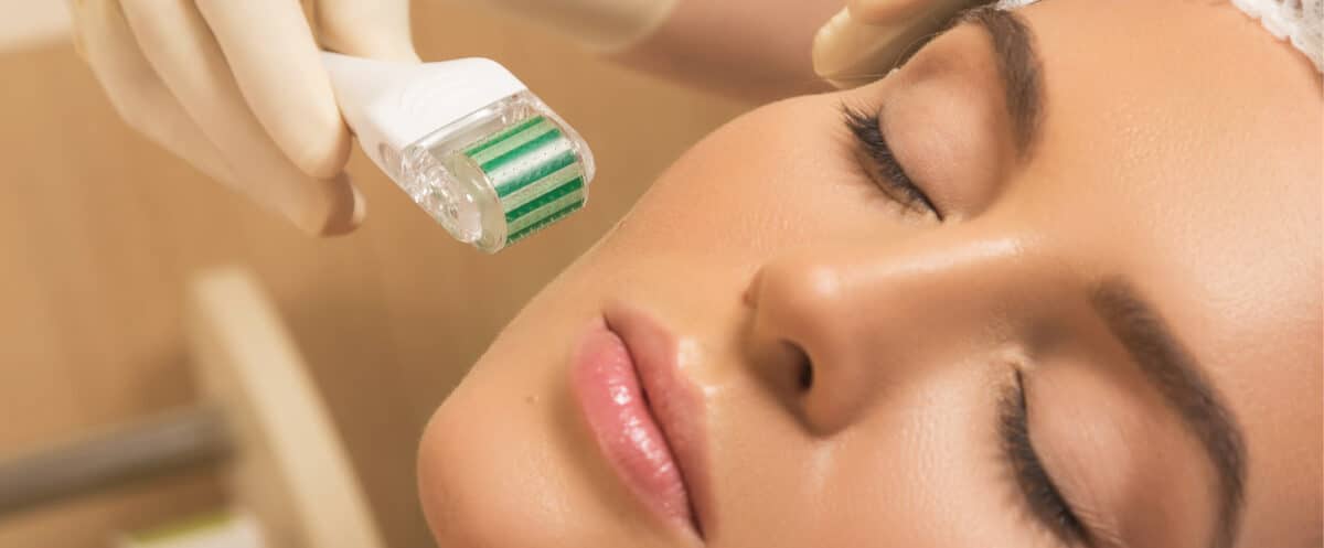 Dermaroller: o microagulhamento no tratamento de cicatriz de acne e ...